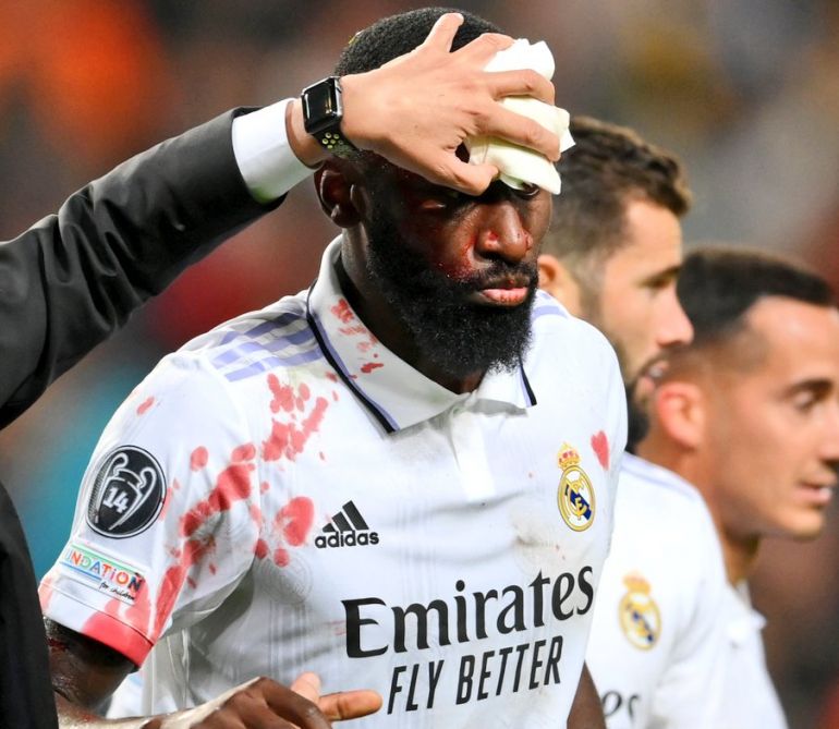 Antonio Rudiger awaiting further tests following 20 stitches in face ...